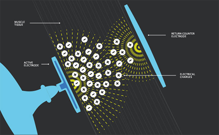 How it Works - Human Tecar